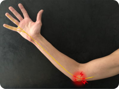 Dr Alain Tchurukdichian | Compression nerf cubital au coude